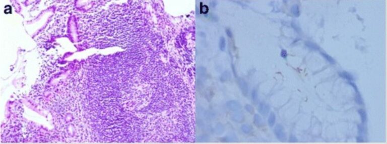 Linfoma MALT | Concise Medical Knowledge