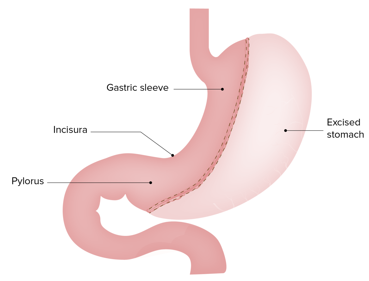 Bariatric Surgery | Concise Medical Knowledge