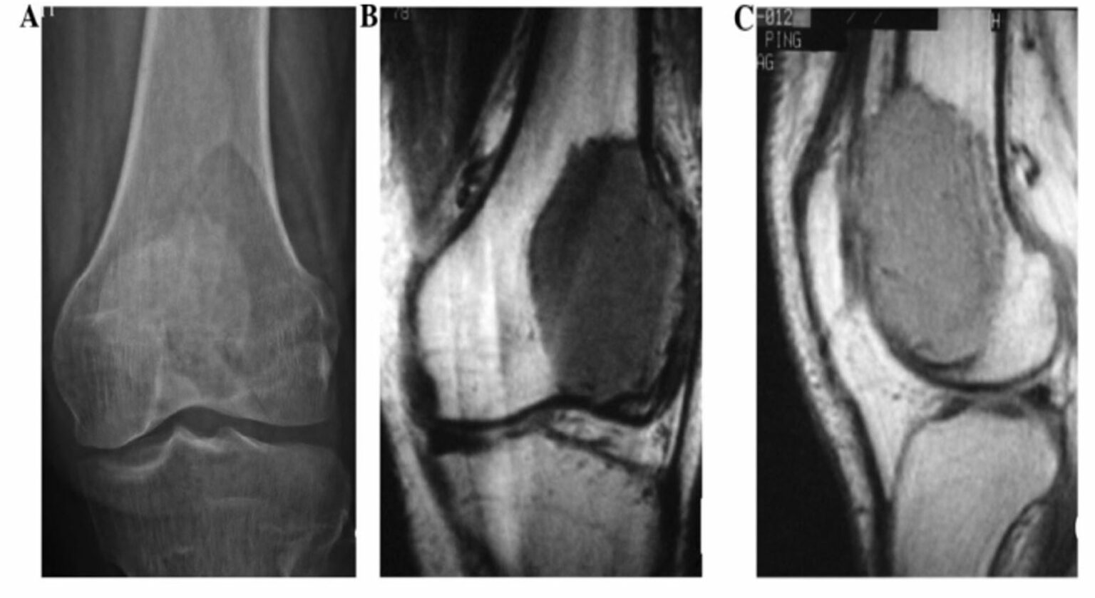 Tumores Óseos Benignos | Concise Medical Knowledge