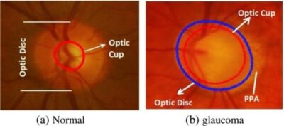 Glaucoma | Concise Medical Knowledge