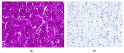 Cellular Accumulations | Concise Medical Knowledge