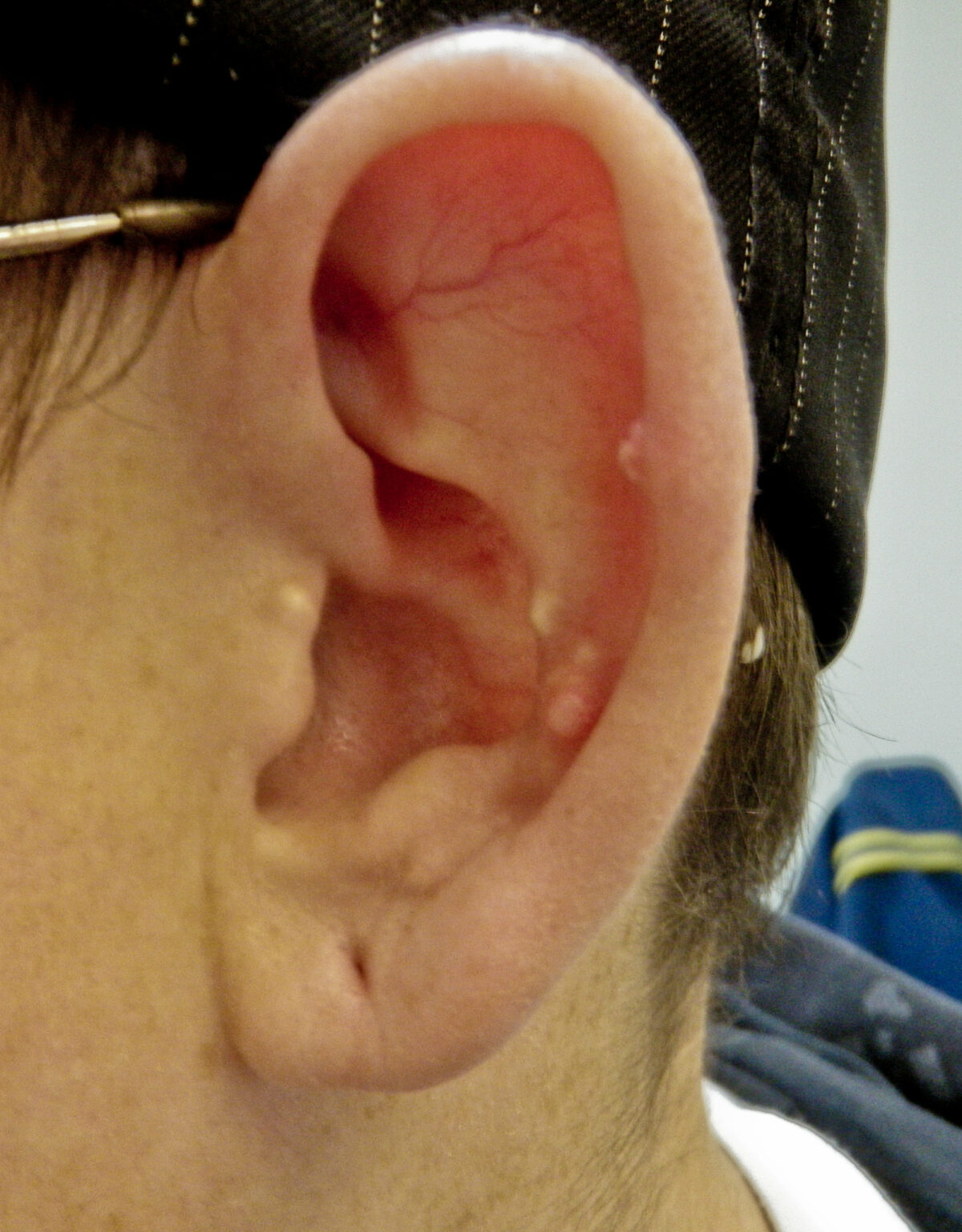 Gout | Concise Medical Knowledge