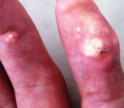 Gota | Concise Medical Knowledge