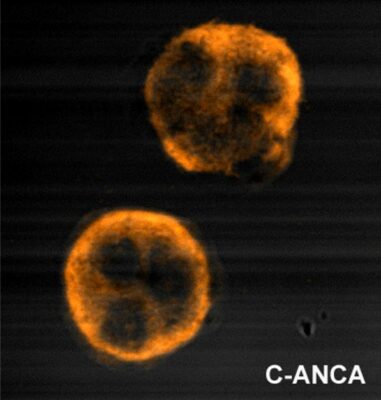 Antineutrophil Cytoplasmic Antibody (ANCA)-Associated Vasculitis ...