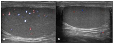 Imagenología Escrotal | Concise Medical Knowledge