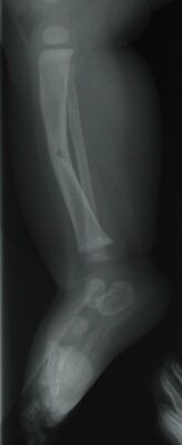 Greenstick Fracture: Definition & Treatment | Lecturio Medical