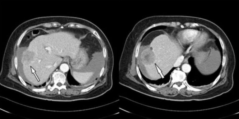 Hepatocellular Carcinoma (HCC) and Liver Metastases | Concise Medical ...