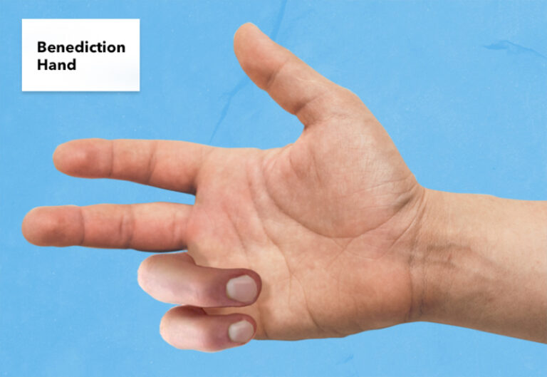 Mononeuropathy and Plexopathy | Concise Medical Knowledge