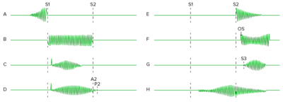 Heart Sounds | Concise Medical Knowledge