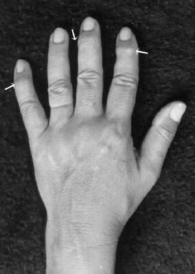 Osteoarthritis | Concise Medical Knowledge
