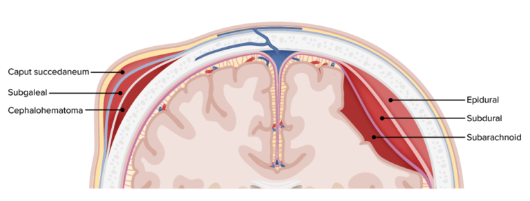 Subdural Hemorrhage | Concise Medical Knowledge