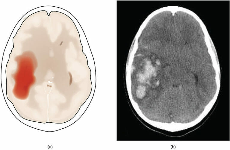 Hemorragia Intracerebral | Concise Medical Knowledge