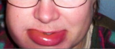 Hereditary Angioedema (C1 Esterase Inhibitor Deficiency) | Concise ...