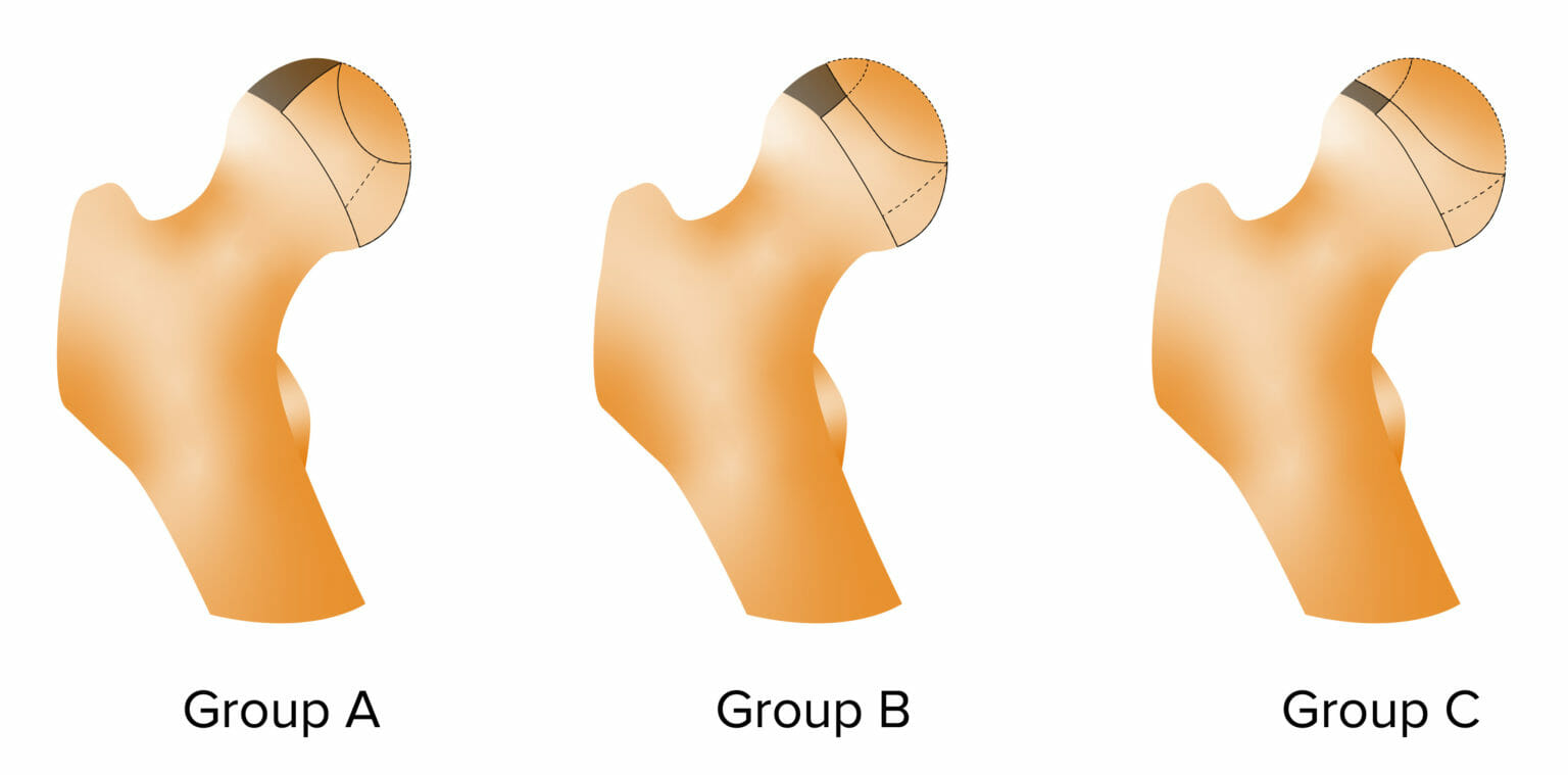 Enfermedad de Legg-Calvé-Perthes | Concise Medical Knowledge