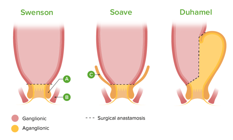 Hirschsprung Disease (Clinical) | Concise Medical Knowledge