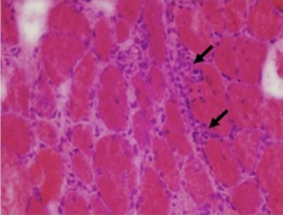 Polymyositis | Concise Medical Knowledge
