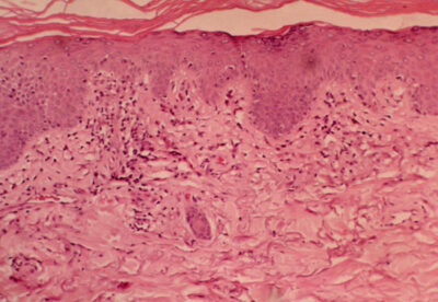 Dermatomyositis | Concise Medical Knowledge
