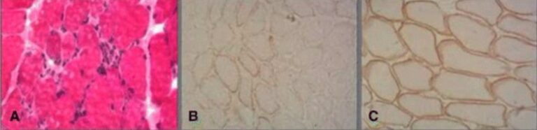 Distrofia Muscular de Becker | Concise Medical Knowledge