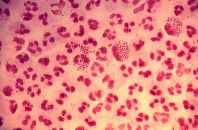 Gonorrhea | Concise Medical Knowledge