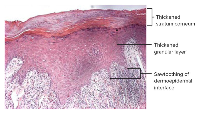 Líquen Plano | Concise Medical Knowledge