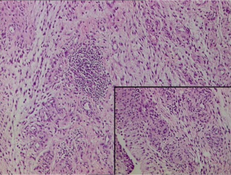 Rheumatoid Arthritis | Concise Medical Knowledge
