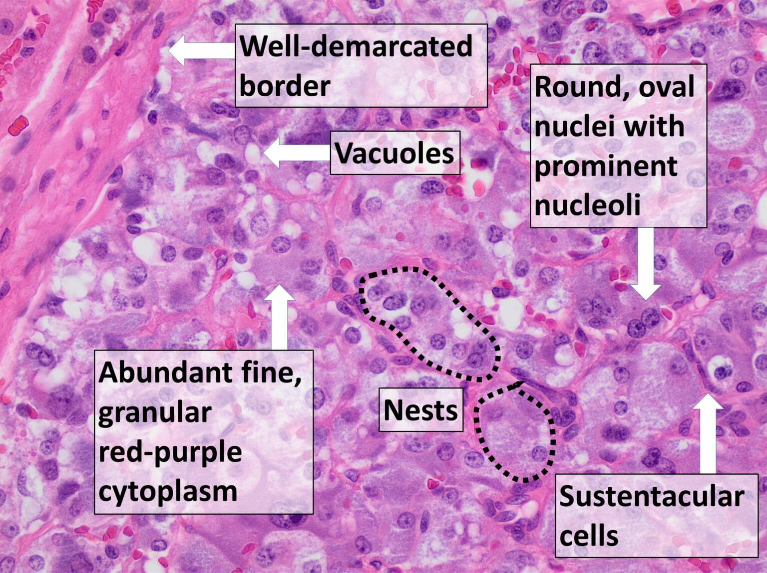 Feocromocitoma | Concise Medical Knowledge