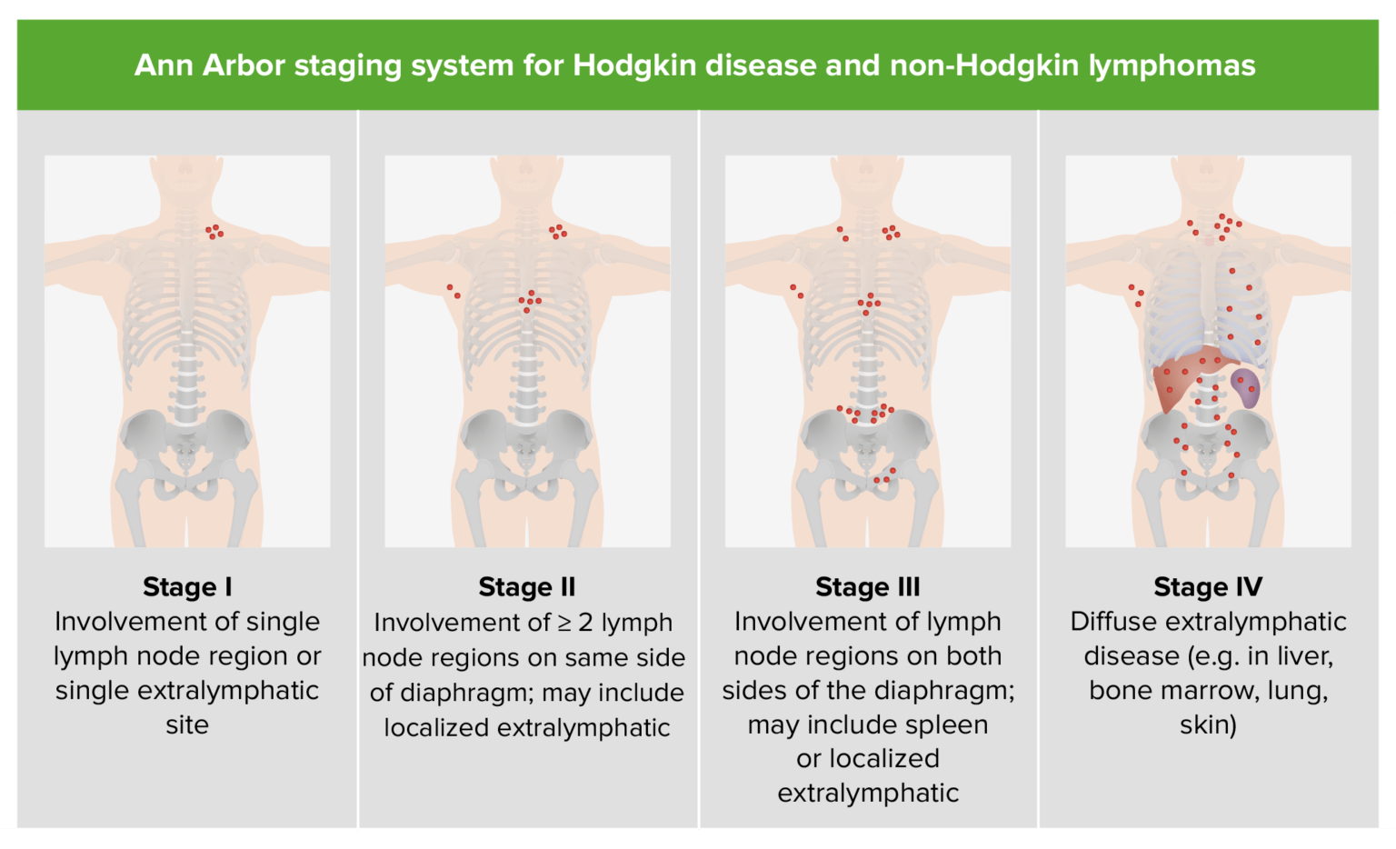 Non-Hodgkin Lymphomas | Concise Medical Knowledge