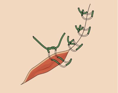 Surgical Instruments and Sutures | Concise Medical Knowledge