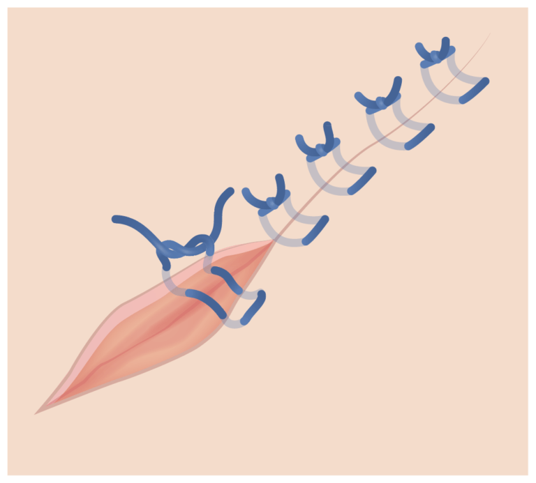 Surgical Instruments and Sutures | Concise Medical Knowledge