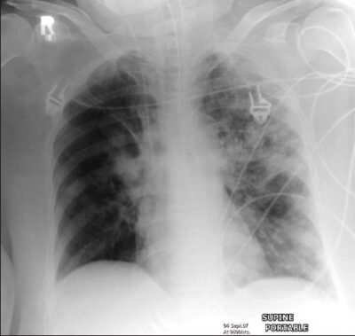 Vírus Influenza/Gripe | Concise Medical Knowledge