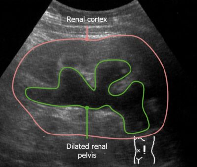 Doença Renal Crónica | Concise Medical Knowledge