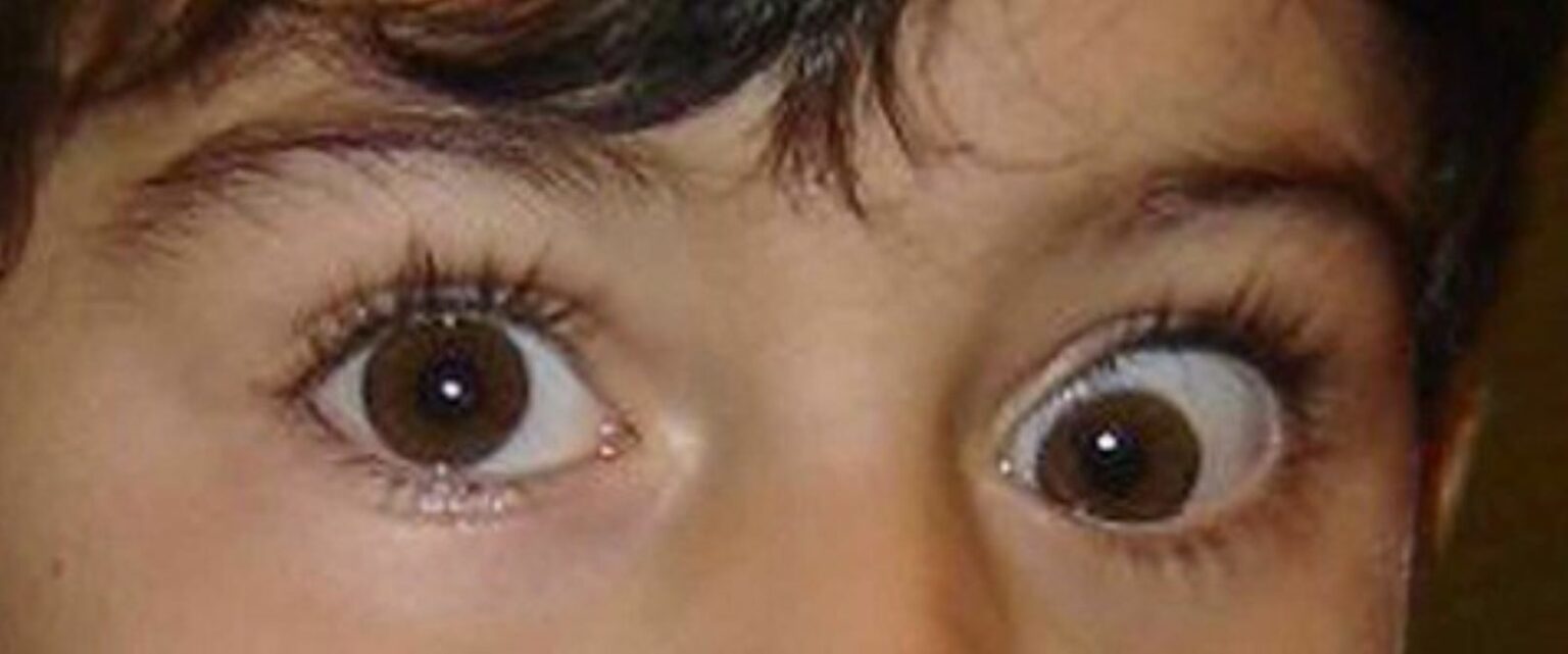 Estrabismo | Concise Medical Knowledge