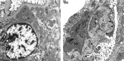 Síndrome Nefrítica | Concise Medical Knowledge