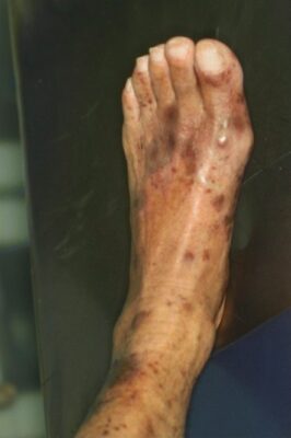 Immune Thrombocytopenic Purpura | Concise Medical Knowledge