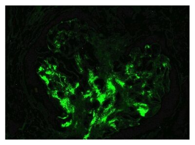 IgA Nephropathy | Concise Medical Knowledge