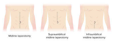 Laparotomy and Laparoscopy | Concise Medical Knowledge