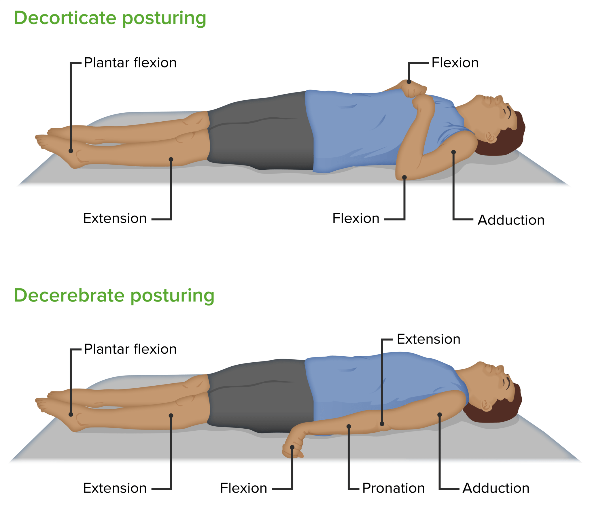 Increased Intracranial Pressure (ICP) | Concise Medical Knowledge