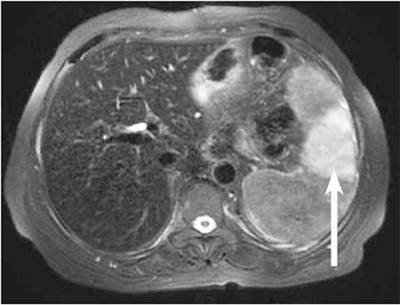 Imaging of the Spleen | Concise Medical Knowledge