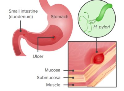 Helicobacter | Concise Medical Knowledge