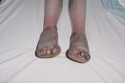 Frostbite | Concise Medical Knowledge