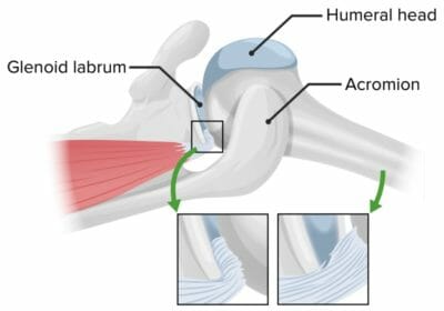 Chronic Shoulder Pain | Concise Medical Knowledge