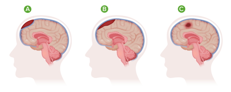 Subdural Hemorrhage | Concise Medical Knowledge