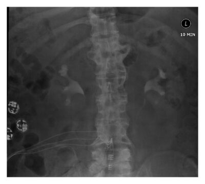 Pyelonephritis and Perinephric Abscess | Concise Medical Knowledge