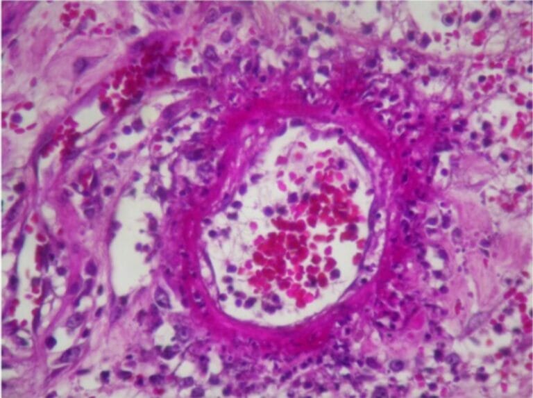 Poliarteritis Nodosa | Concise Medical Knowledge