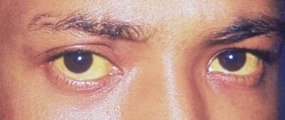 Esferocitose Hereditária | Concise Medical Knowledge
