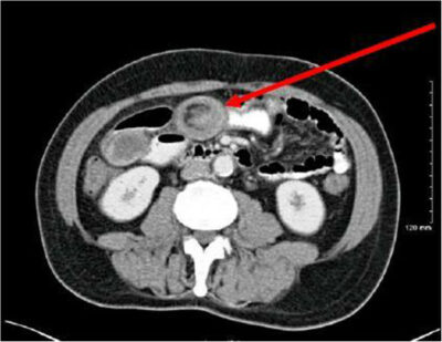 Intussusception | Concise Medical Knowledge