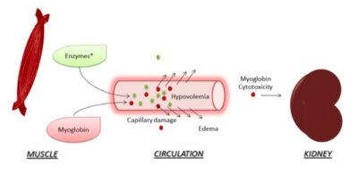 Rabdomiólisis | Concise Medical Knowledge