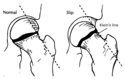 Slipped Capital Femoral Epiphysis | Concise Medical Knowledge