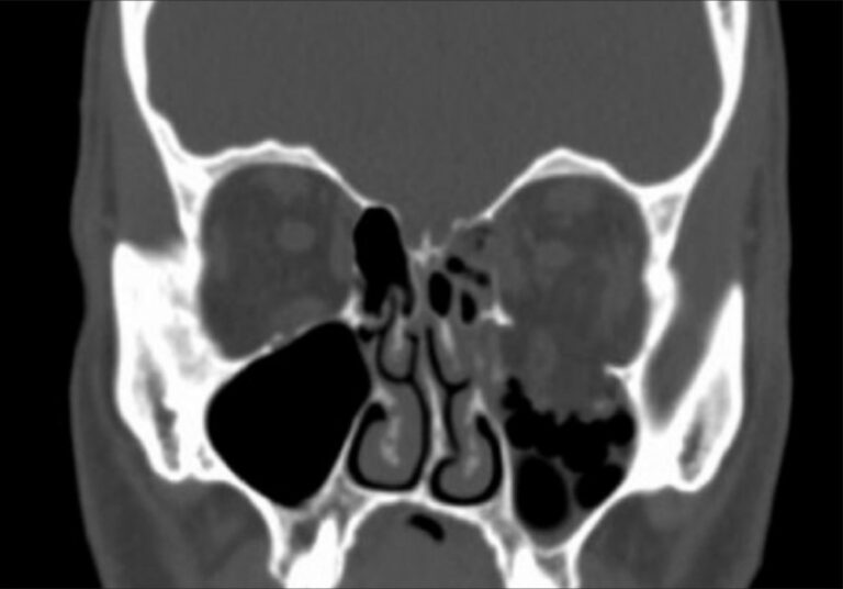 Orbital Fractures | Concise Medical Knowledge