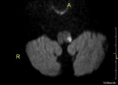 Síndrome Medular Lateral (Síndrome de Wallenberg) | Concise Medical ...